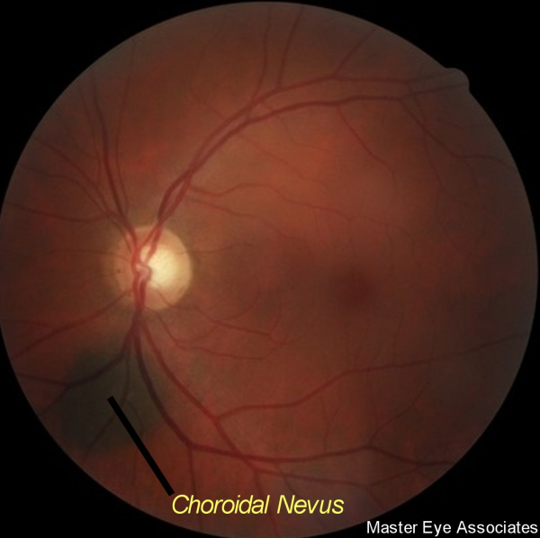 Choroidal Nevus: A Common Eye Condition that can Become Lethal