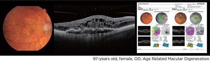 Macular Degeneration Prevention