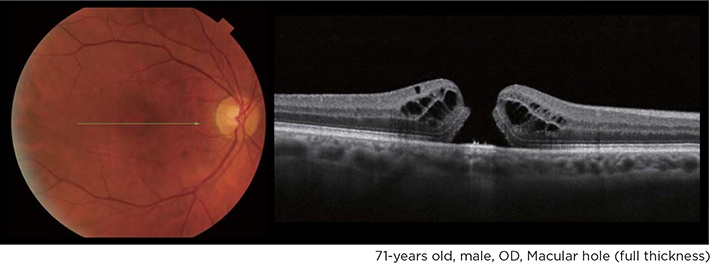 Optical Coherence Tomography OCT Scan