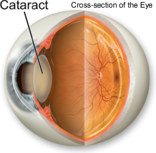Cataracts and Cataract Surgery