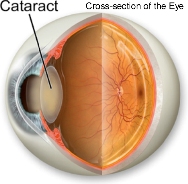 Cataracts and Cataract Surgery