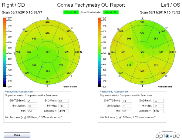 Optical Coherence Tomography OCT Scan