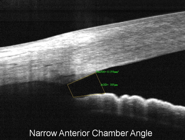 Optical Coherence Tomography OCT Scan