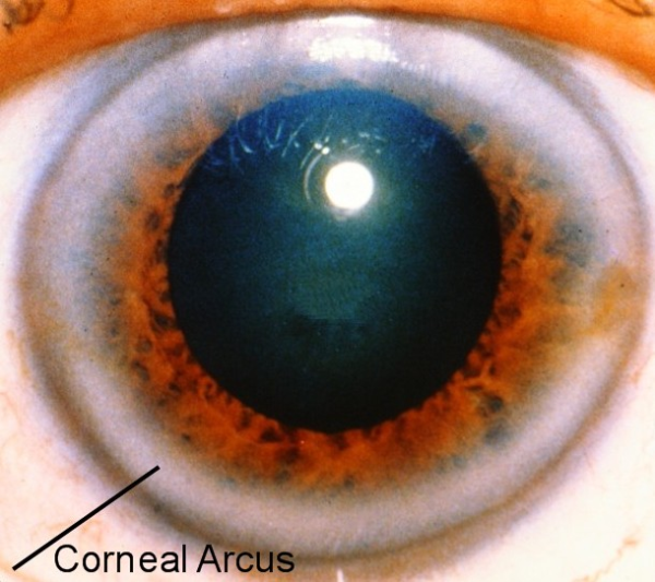 Corneal Arcus (arcus senilis)