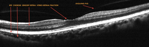 Optical Coherence Tomography OCT Scan
